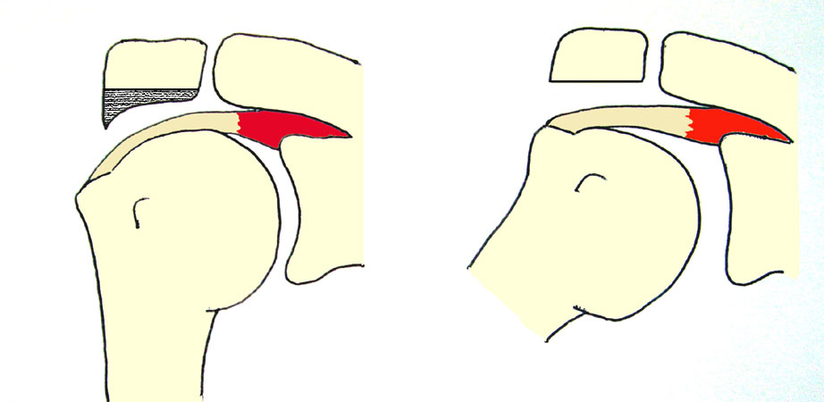 L'acromioplastie arthroscopique